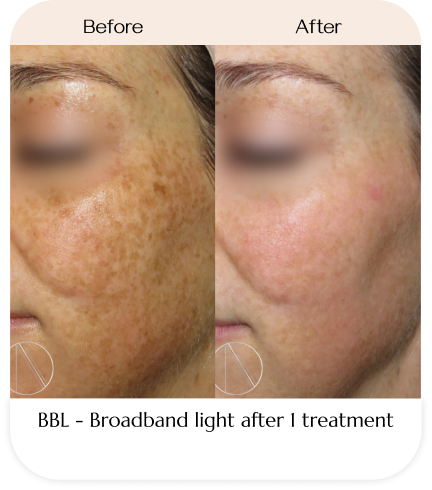 Sciton BBL Treatment | Broadband Light in Fort Lauderdale, FL